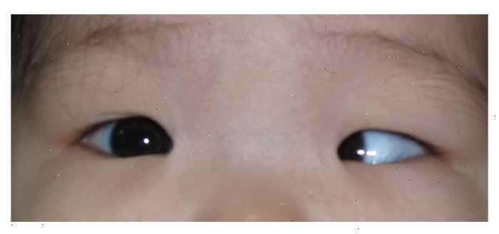 Squint (skelning) hos barn – Nadata