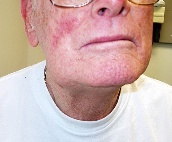 Mouth (muntlig) cancer – Nadata